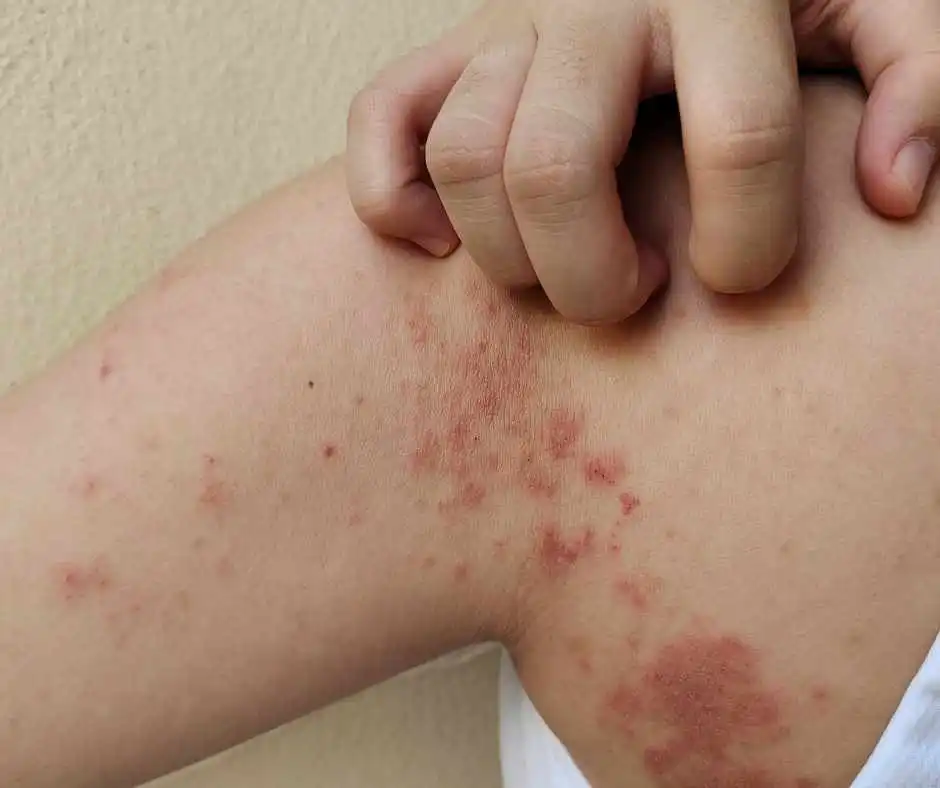 Kusta: Kenali Gejala, Penyebab, dan Penanganannya